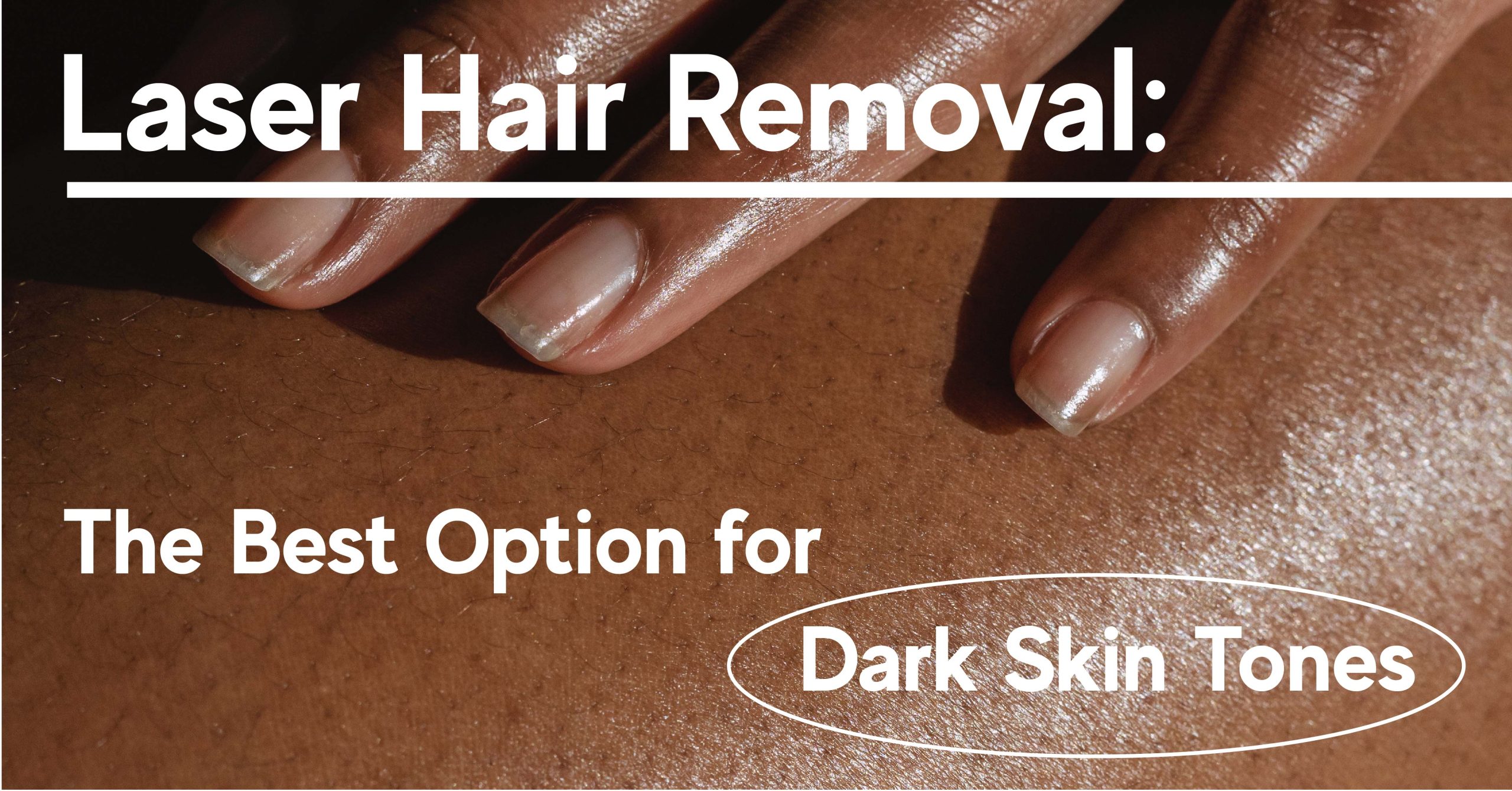Laser Hair Removal The Best Option for Dark Skin Tones AllWhite Laser AW3